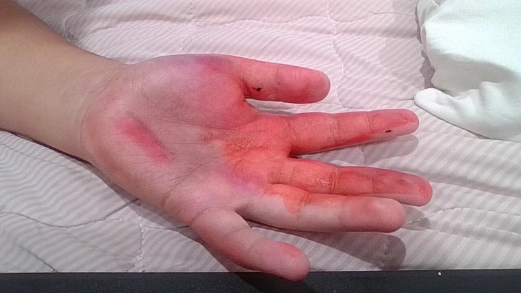 Guys! Look at my gore-ifyed hand! (TW: Fake blood!) | Fandom