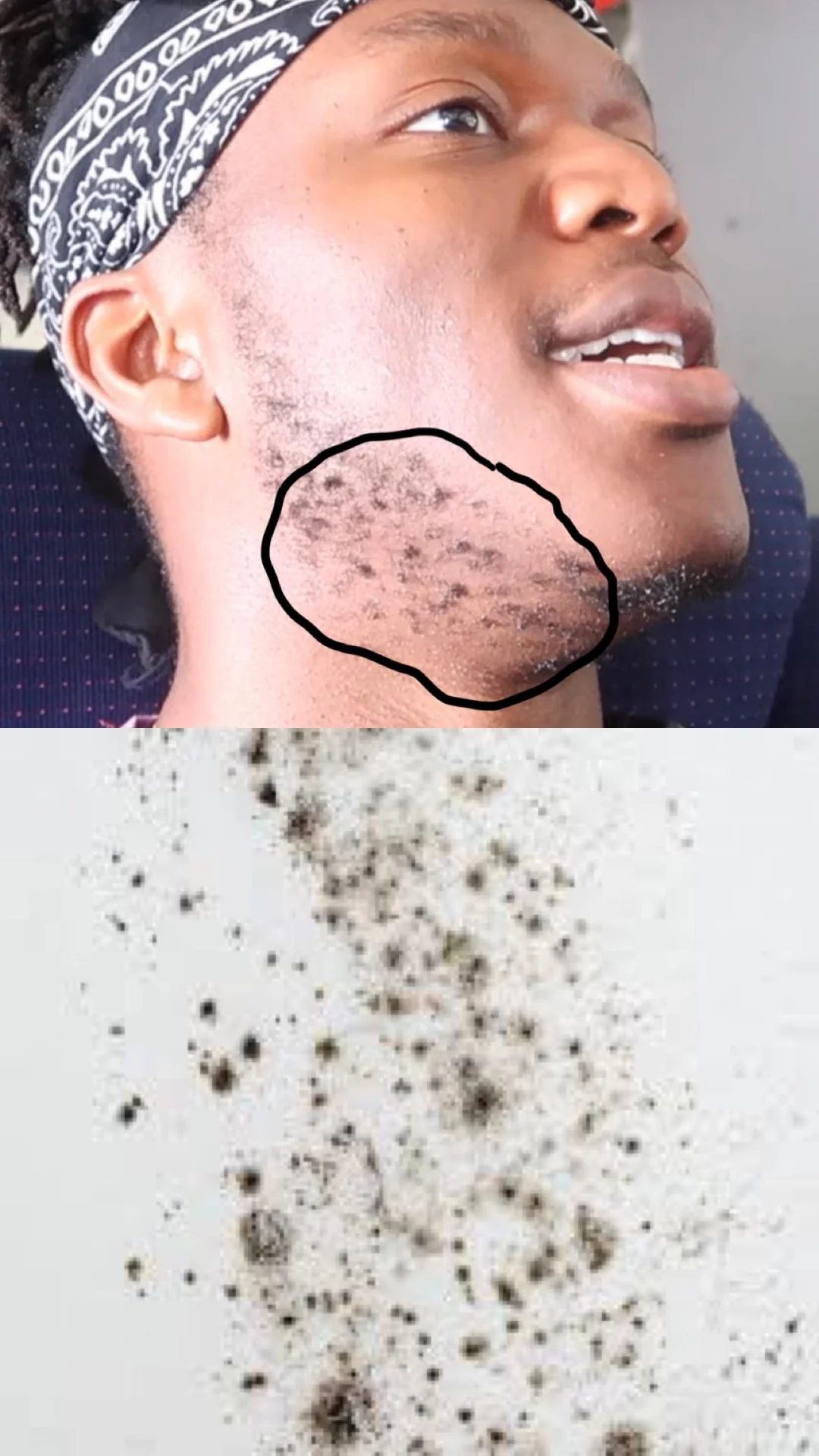 KSI has vominous black mold on his face. Spread the word in hopes that ...