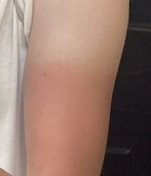 Sunburn tan line is unacceptable | Fandom