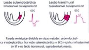 Infarto do Miocárdio | Wiki AIA 13-17 | Fandom