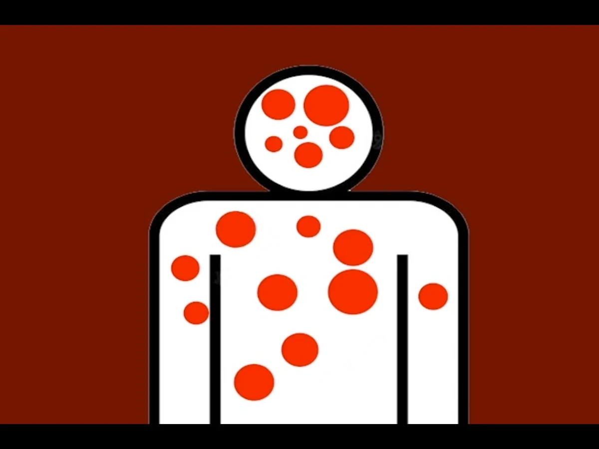 Omega Helminths | Analog Conditions and Diseases Wiki | Fandom