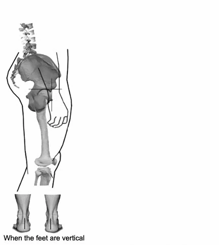Short Leg Syndrome (aka Functional Leg Length Discrepancy) | Athlepedia ...