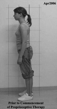 Treating the PreClinical Clubfoot Deformity using Proprioceptive ...