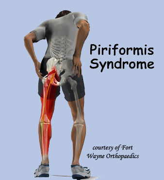 Piriformis Syndrome - Burning in the Heel Bone | Athlepedia, The ...