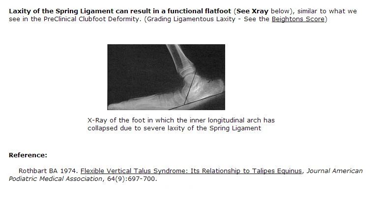 Spring (Calcaneonavicular) Ligament Laxity | Athlepedia, The Athletics ...