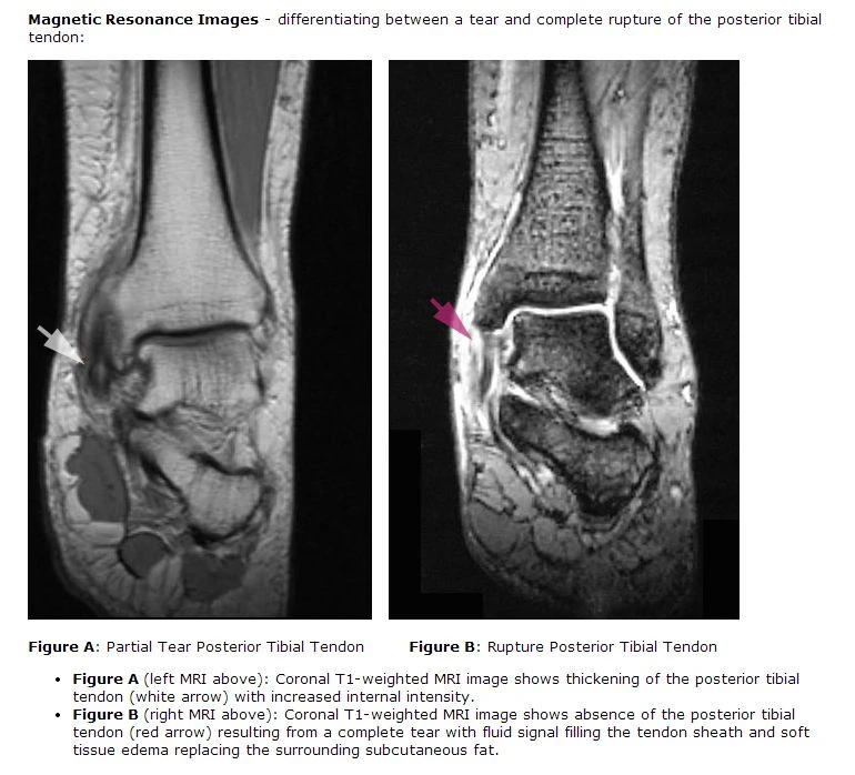 Posterior Tibial Tendon Dysfunction | Athlepedia, The Athletics Wiki ...