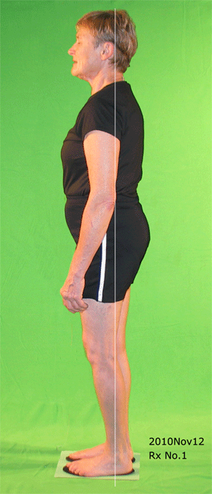 Treating The Preclinical Clubfoot Deformity Using Proprioceptive