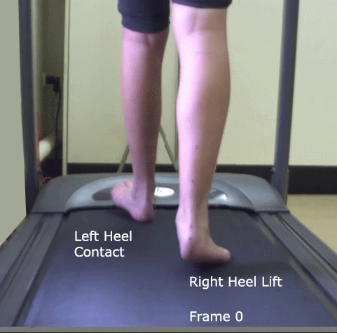 Typical Findings in Treadmill Analysis of the PreClinical Clubfoot ...