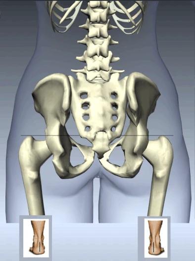 Functional Leg Length Discrepancy - Foot to Innominate Link ...