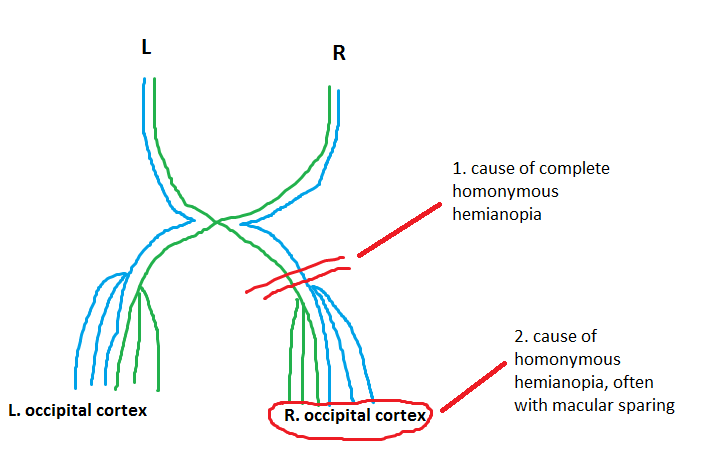 Homonymous Hemianopia Bitemporal Hemianopia | Barts Wiki | Fandom