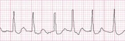 Atrial fibrillation | BMET Wiki | Fandom