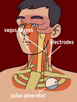 Hiccups | BrainPOP Wiki | Fandom