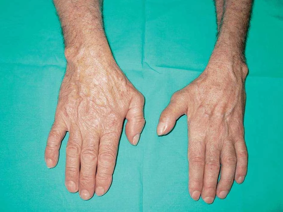 Atrofia | Capítulo XI: Enfermedades del aparato digestivo Wiki | Fandom