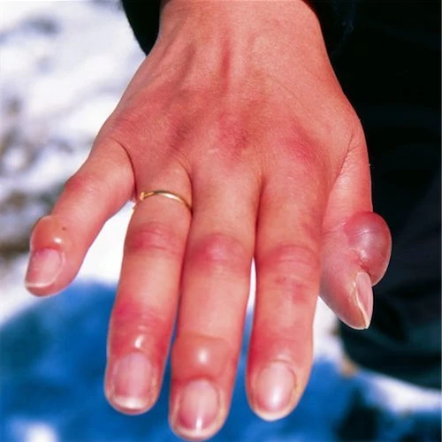 Frostbite | Color Sorting | Fandom