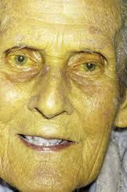 Jaundice | The Coterie Wiki | Fandom