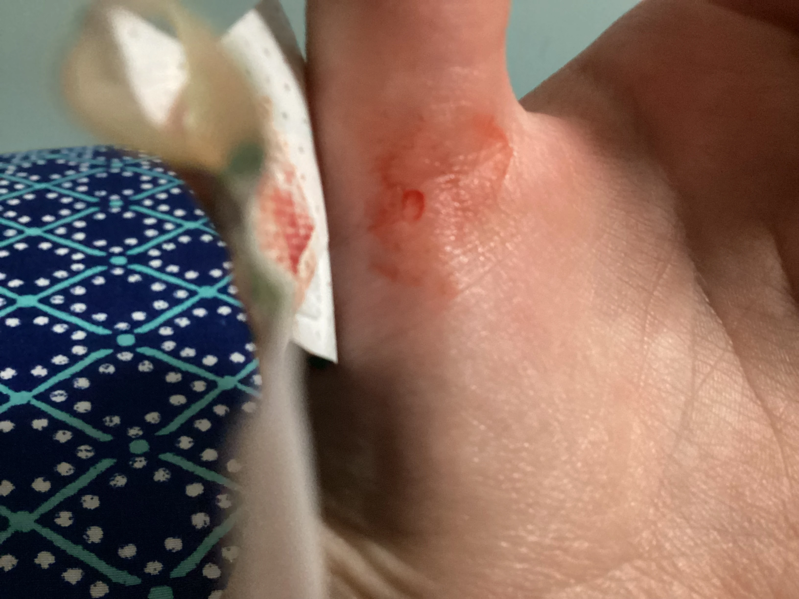 Yeowch (blood warning) | Fandom