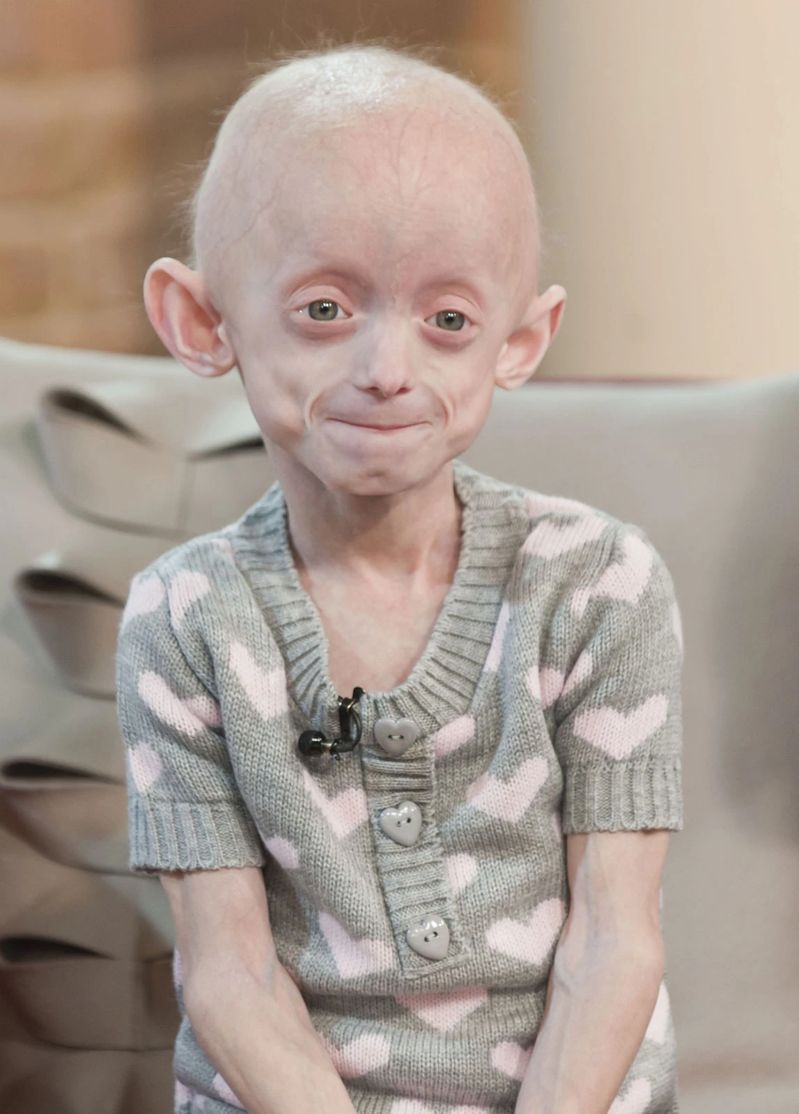Progeria | Disease Wiki | Fandom