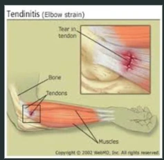 Tendinitis | Disease/disorder Wiki | Fandom