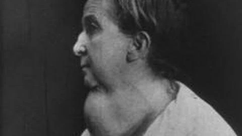 Simple Goiter | Educational Film Wiki | Fandom