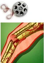 Botbreuk | EHBO Wiki | Fandom