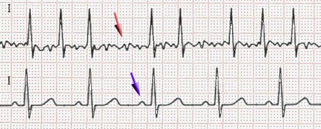 Atrial fibrillation | House Wiki | Fandom