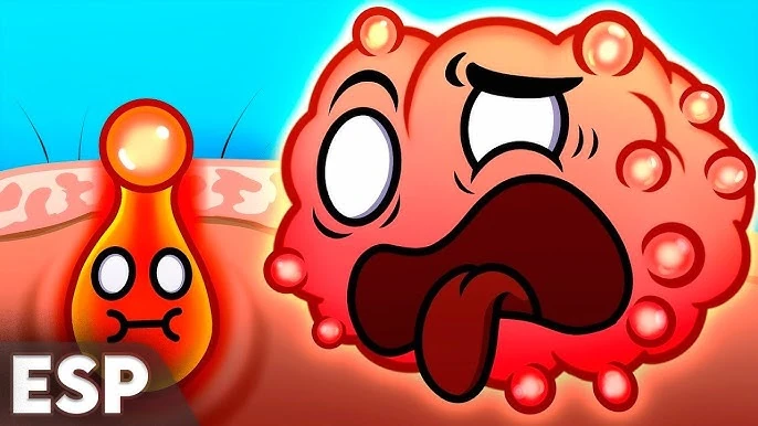 ¡Como Eliminar el Acné! | Wiki Human Buddy Español | Fandom
