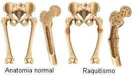 Raquitismo | Infomedica Wiki | Fandom