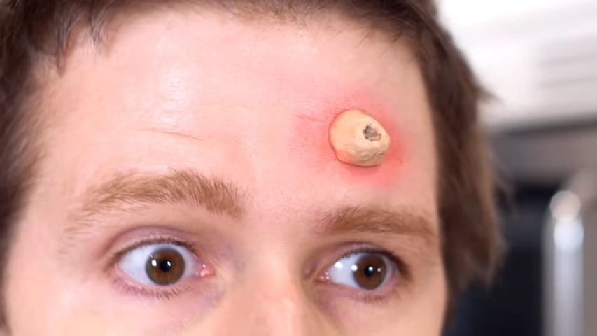 BIG WART ON FACE! | JesseAndMike Wiki | Fandom