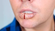 HUGE BUSTED LIP!/Transcript | JesseAndMike Wiki | Fandom
