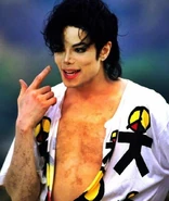 Vitiligo | Michael Jackson Wiki | Fandom