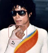 Vitiligo | Michael Jackson Wiki | Fandom