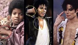 Vitiligo | Michael Jackson Wiki | Fandom