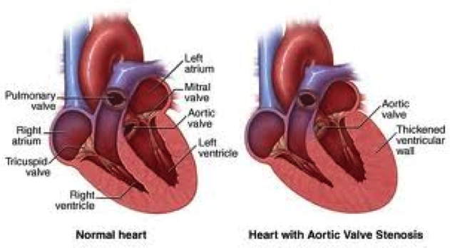 Aortic Stenosis | My Medical Handbook Wiki | Fandom