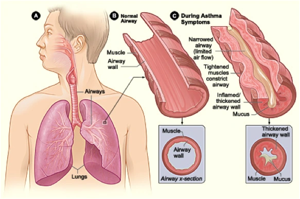 Asthma | My Medical Handbook Wiki | Fandom