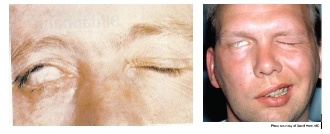 Tentamen TP3MO1 Öron näsa hals med svar | Odontologi GU Wikia | Fandom