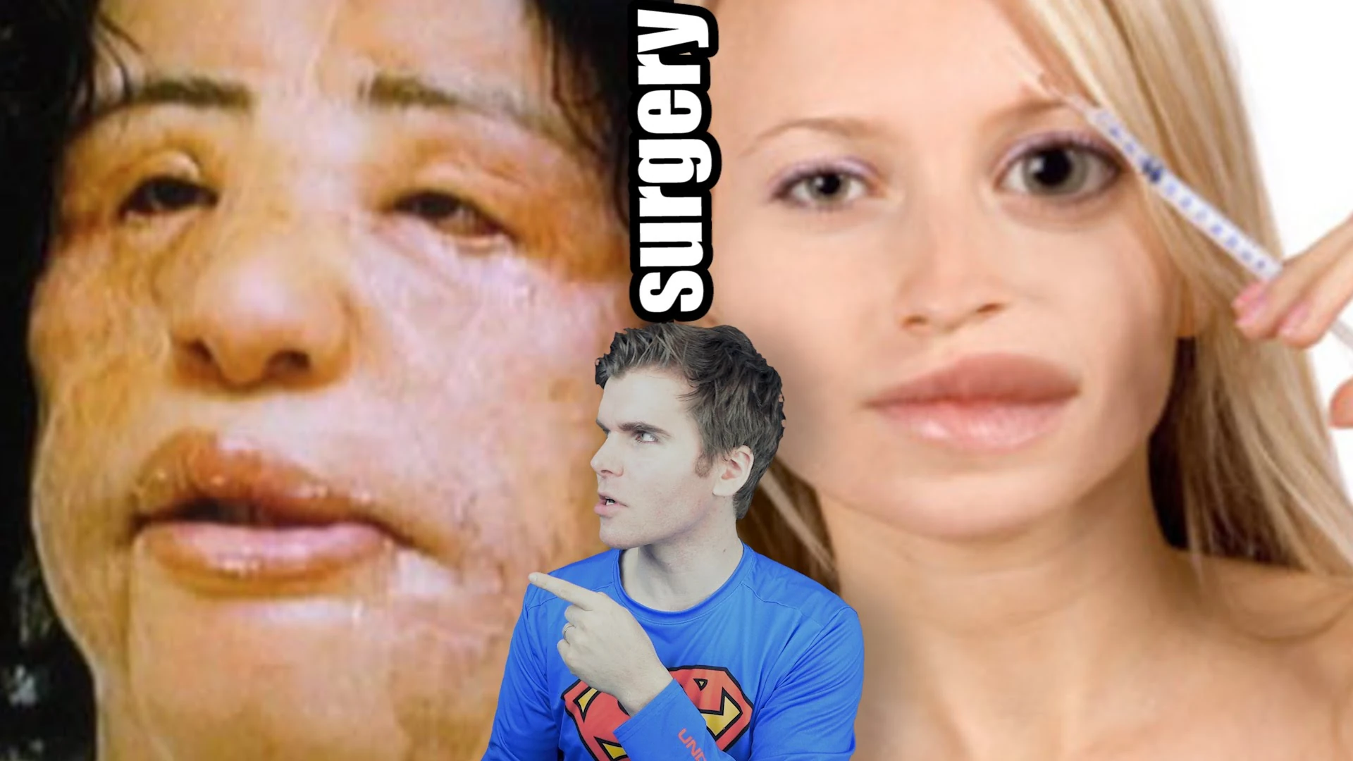 Plastic Surgery Gone Wrong Before And After Pictures