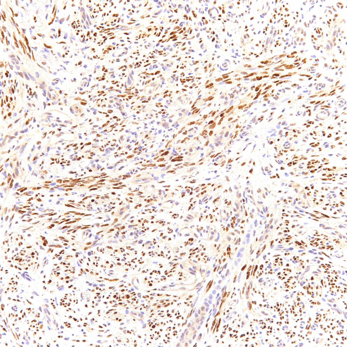 Human Herpesvirus 8 (HHV-8) | Pathology Resident Wiki | Fandom