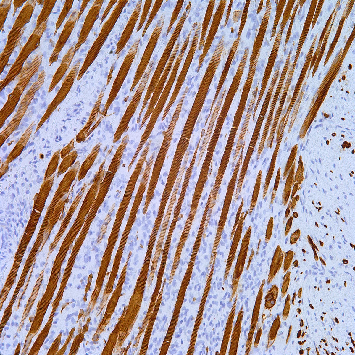 Desmin | Pathology Resident Wiki | Fandom