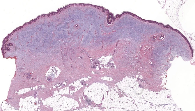 Pretibial Myxedema with Intramuscular Soft Tissue Involvement in a ...