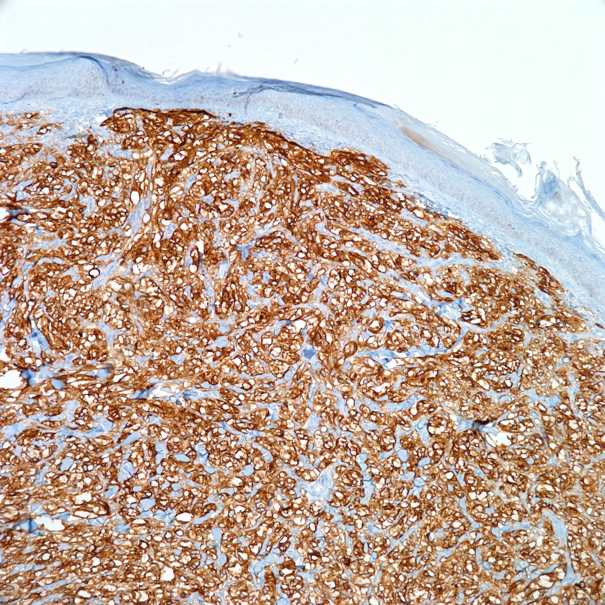 CD10 | Pathology Resident Wiki | Fandom