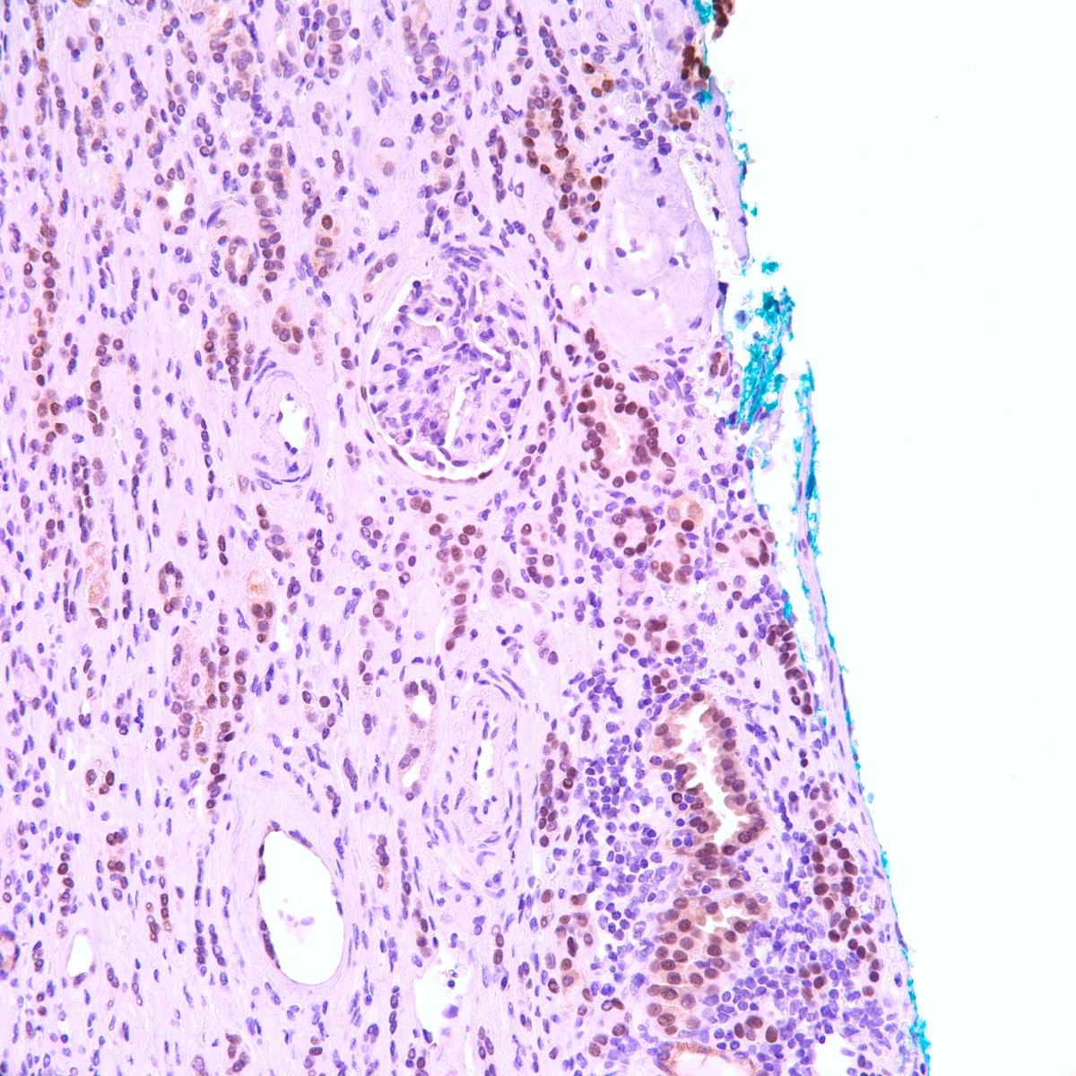 Pax2 | Pathology Resident Wiki | Fandom