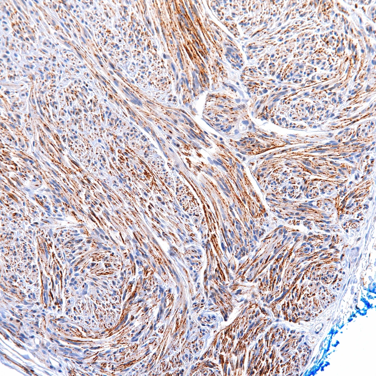 Protein Gene Product 9.5 (PGP9.5) | Pathology Resident Wiki | Fandom
