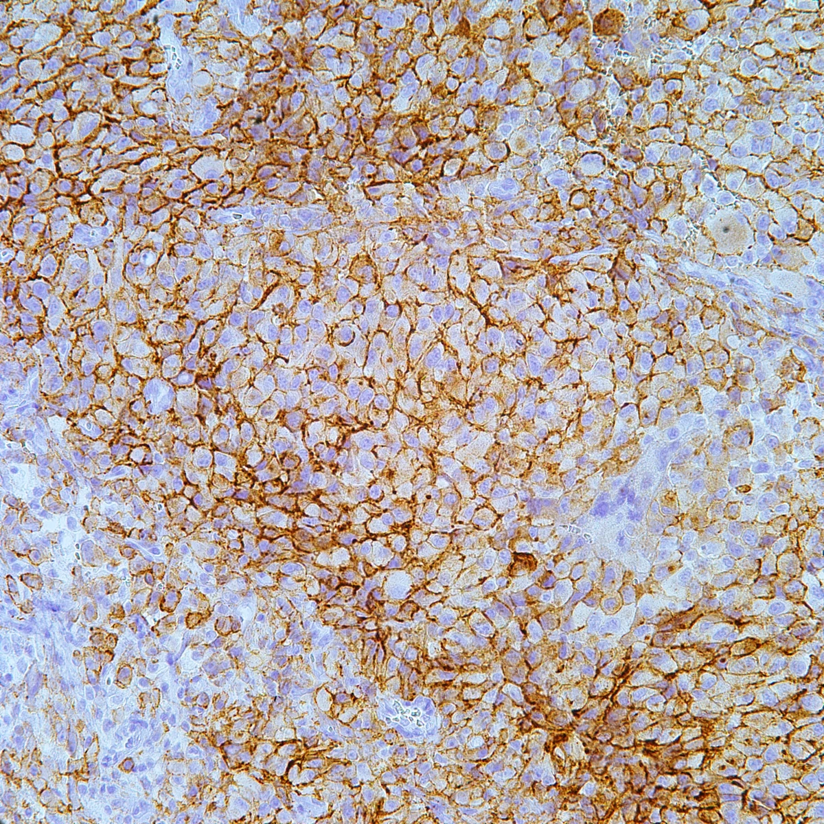 Epithelial Membrane Antigen (EMA) | Pathology Resident Wiki | Fandom