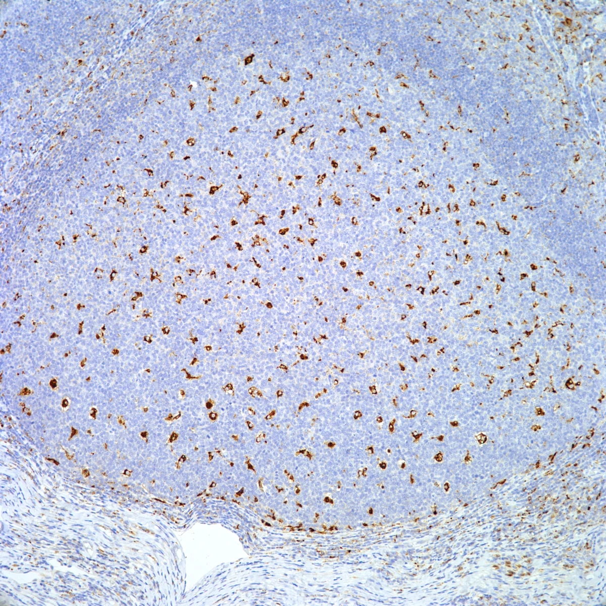 CD68 (KP-1) | Pathology Resident Wiki | Fandom