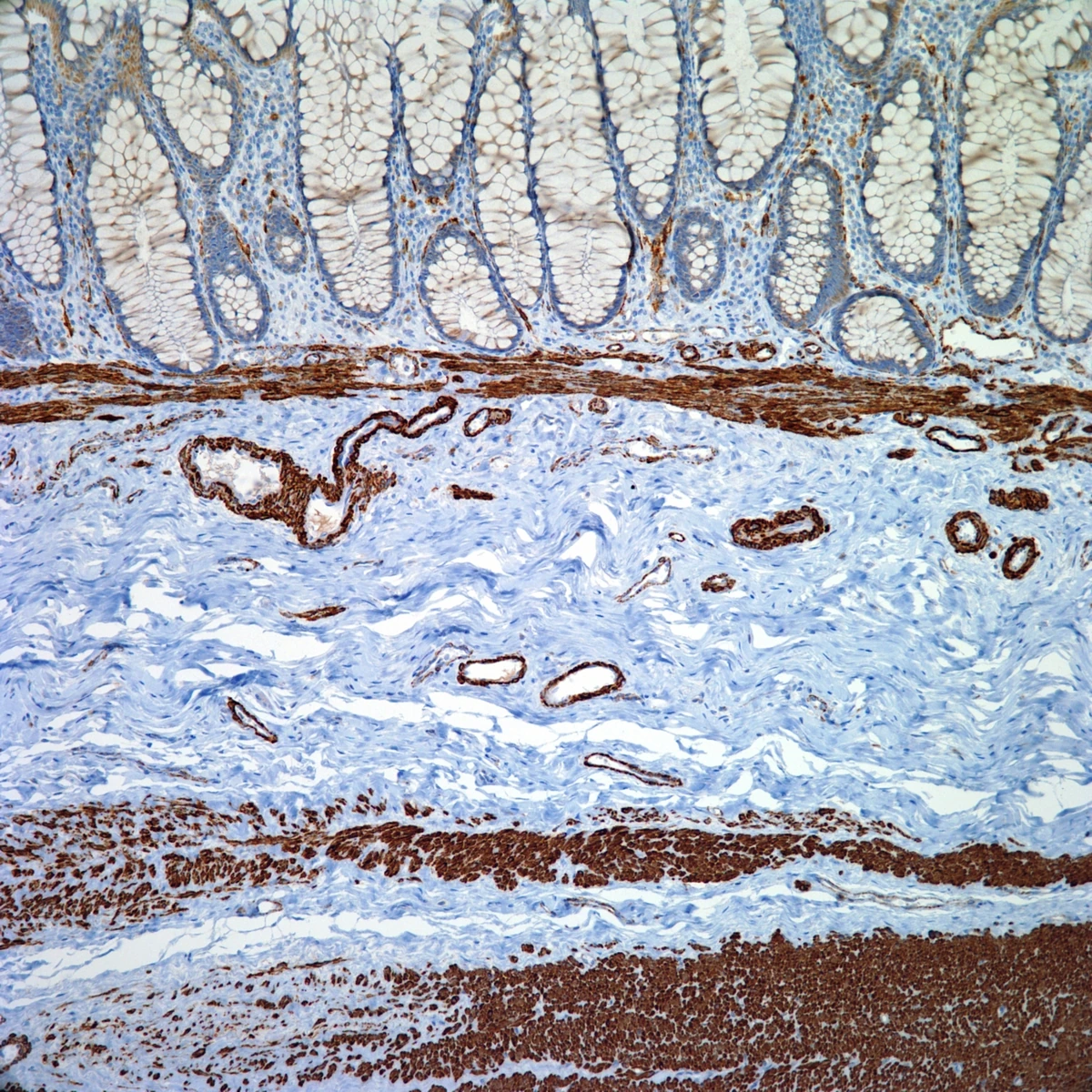 Muscle Specific Actin (MSA) | Pathology Resident Wiki | Fandom