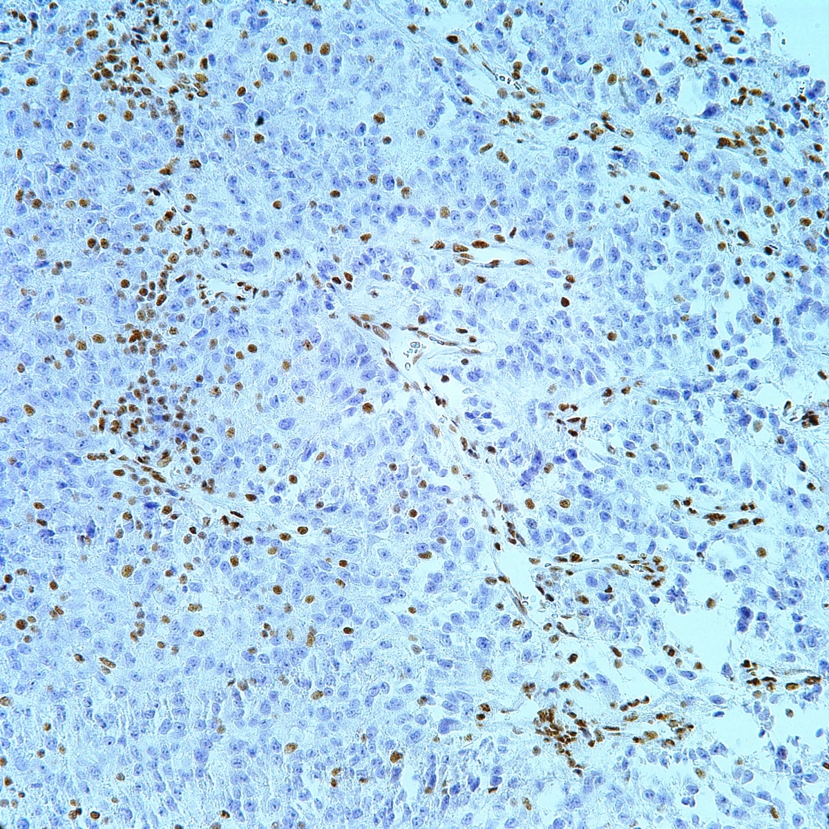 INI-1 | Pathology Resident Wiki | Fandom