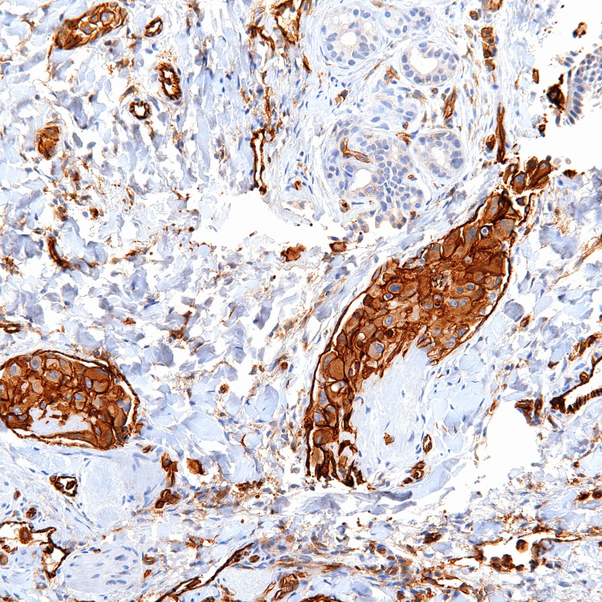 CD31 | Pathology Resident Wiki | Fandom