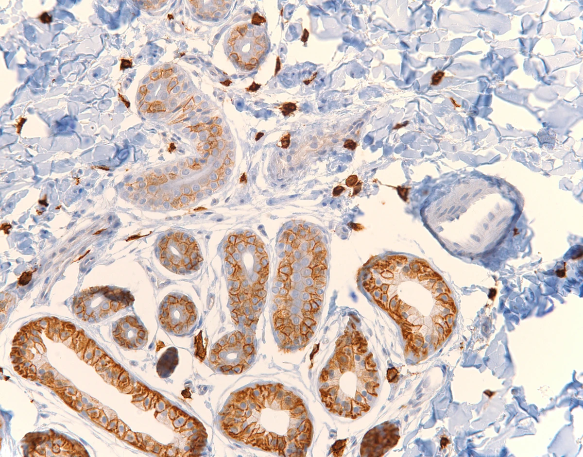CD117 (c-kit) | Pathology Resident Wiki | Fandom