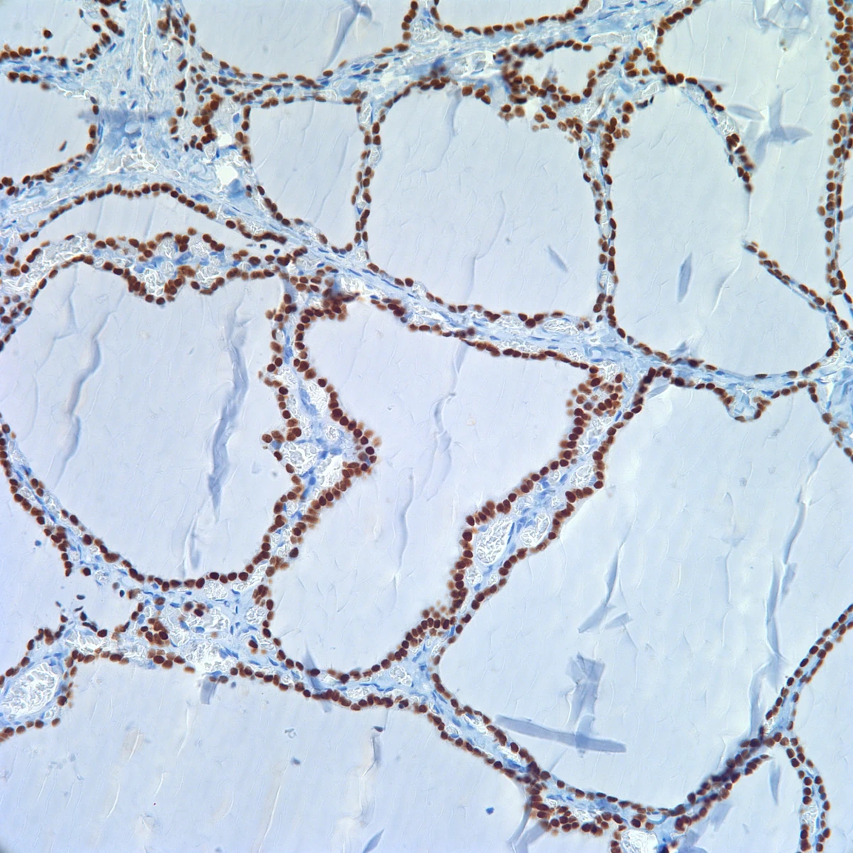 Thyroid Transcription Factor 1 (TTF-1) | Pathology Resident Wiki | Fandom