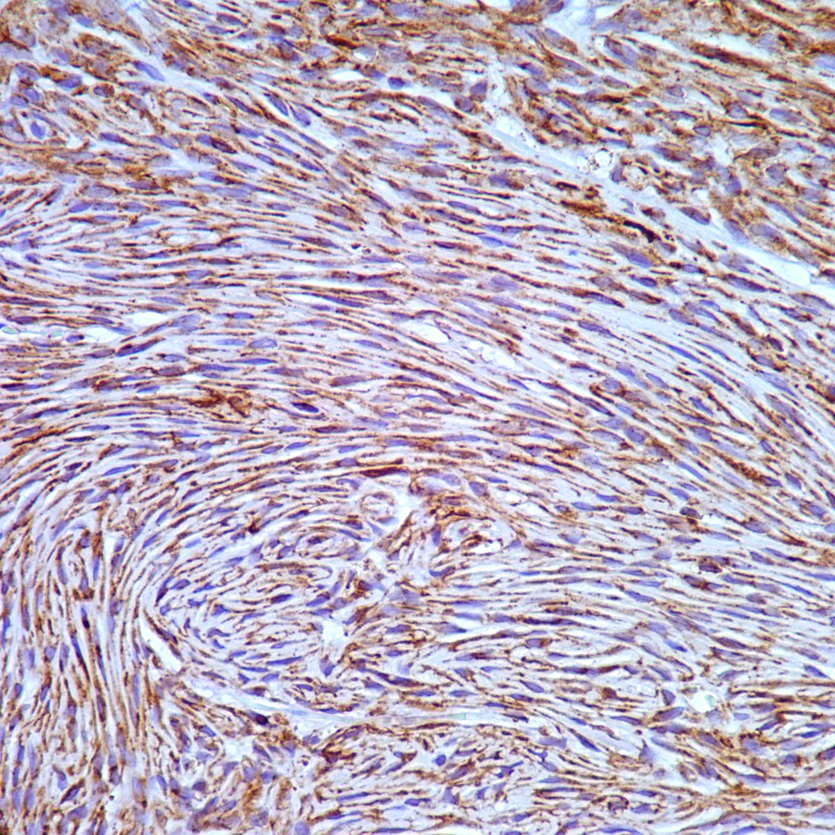 Claudin-1 | Pathology Resident Wiki | Fandom